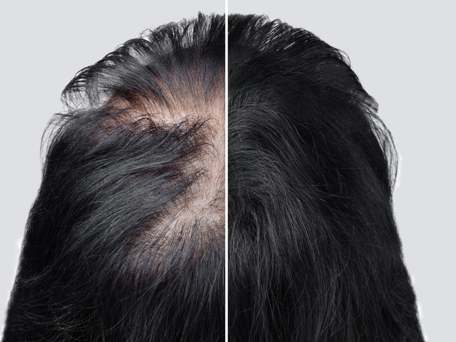 Alopecia and hair loss: Types, causes and how to deal with them - Perea ...