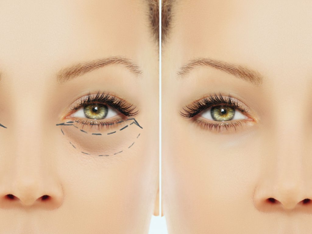 EYELID SURGERY POST -OP TREATMENT - Perea Clinic